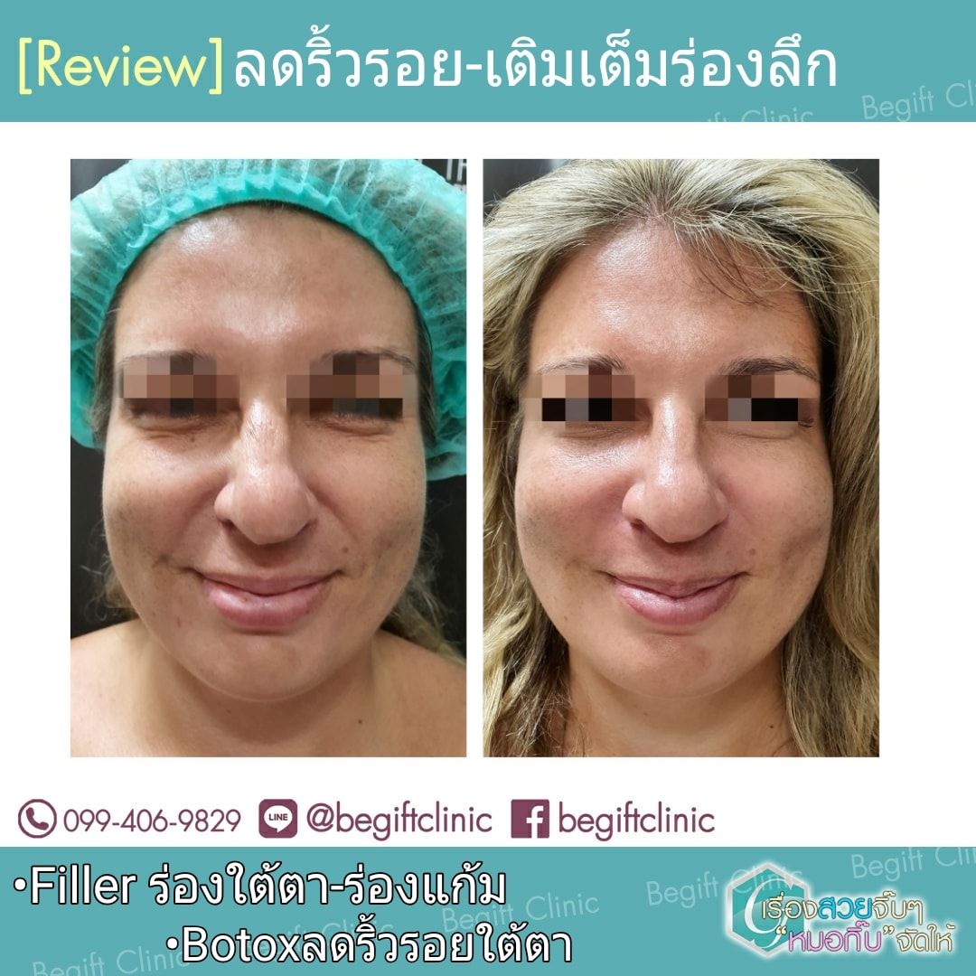 Begift Clinic ปรับรูปหน้าเรียว ร้อยไหม ฟิลเลอร์ คลินิกความงามภูเก็ต