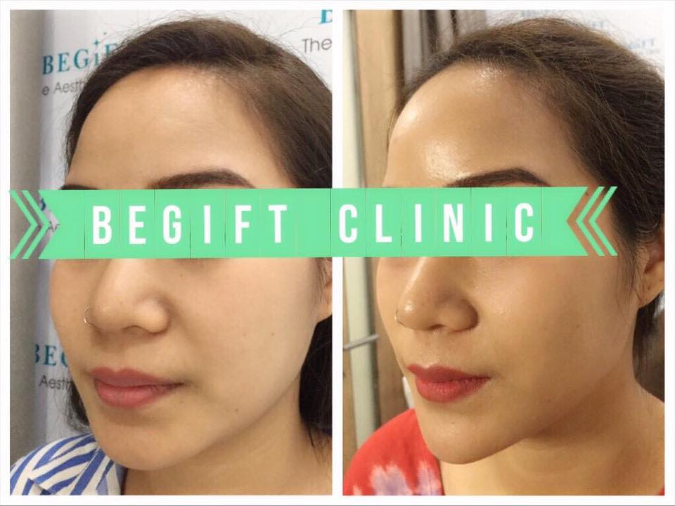 Begift Clinic ปรับรูปหน้าเรียว ร้อยไหม ฟิลเลอร์ คลินิกความงามภูเก็ต