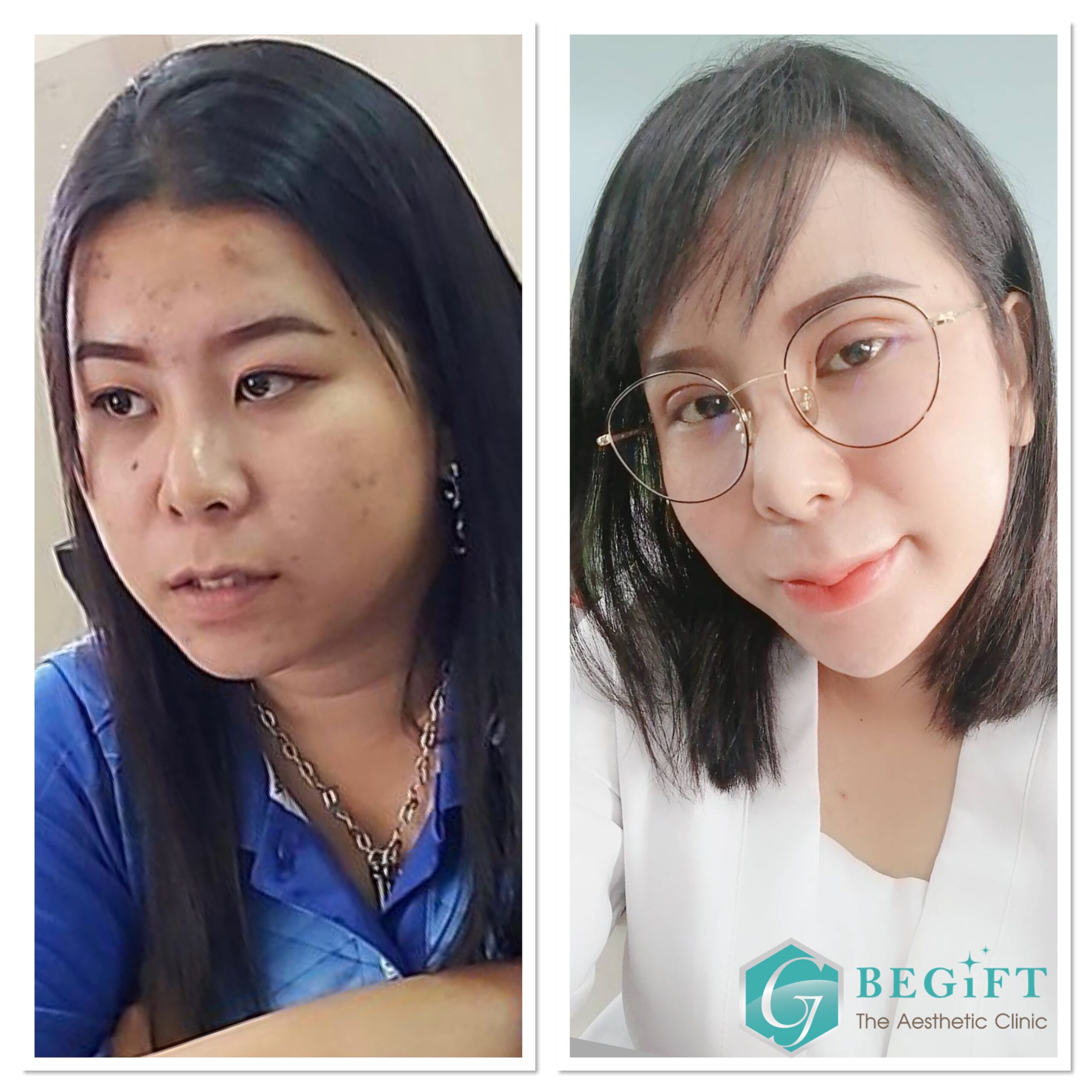 Begift Clinic – ให้บริการปรับรูปหน้าเรียว โดยไม่ต้องศัลยกรรม ไม่ต้องเจ็บตัว ไม่ต้องพักฟื้น