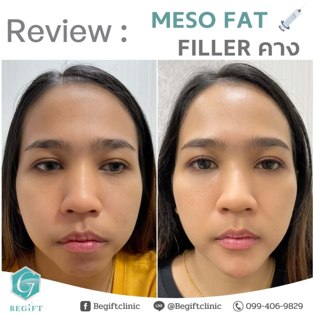 Meso Fat - Begift Clinic เมโสแฟต ฉีดสลายไขมัน ลดแก้ม ลดเหนียง