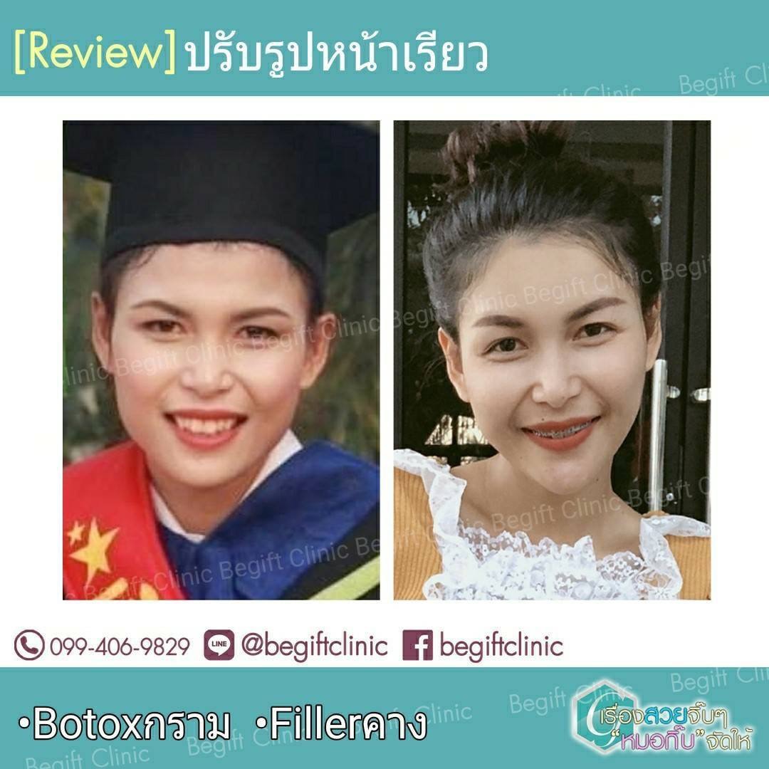 Begift Clinic ปรับรูปหน้าเรียว ร้อยไหม ฟิลเลอร์ โบท็อกซ์ | คลินิกความงามภูเก็ต